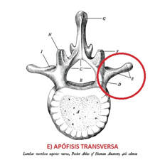 Síndrome de Bertolotti - Mega Apófisis Transversa